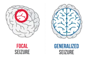 Epilepsy + Seizures: Causes, Signs, and Symptoms