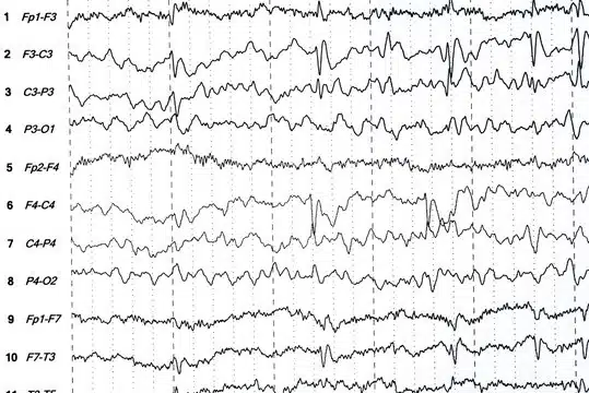 EEG - Electroencephalogram for Epilepsy
