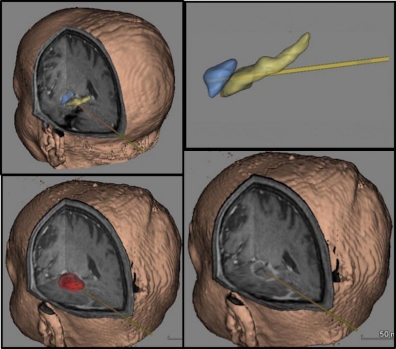 What's the Right Amount of 'Zapping' in Epilepsy Laser Surgery? – CURE ...