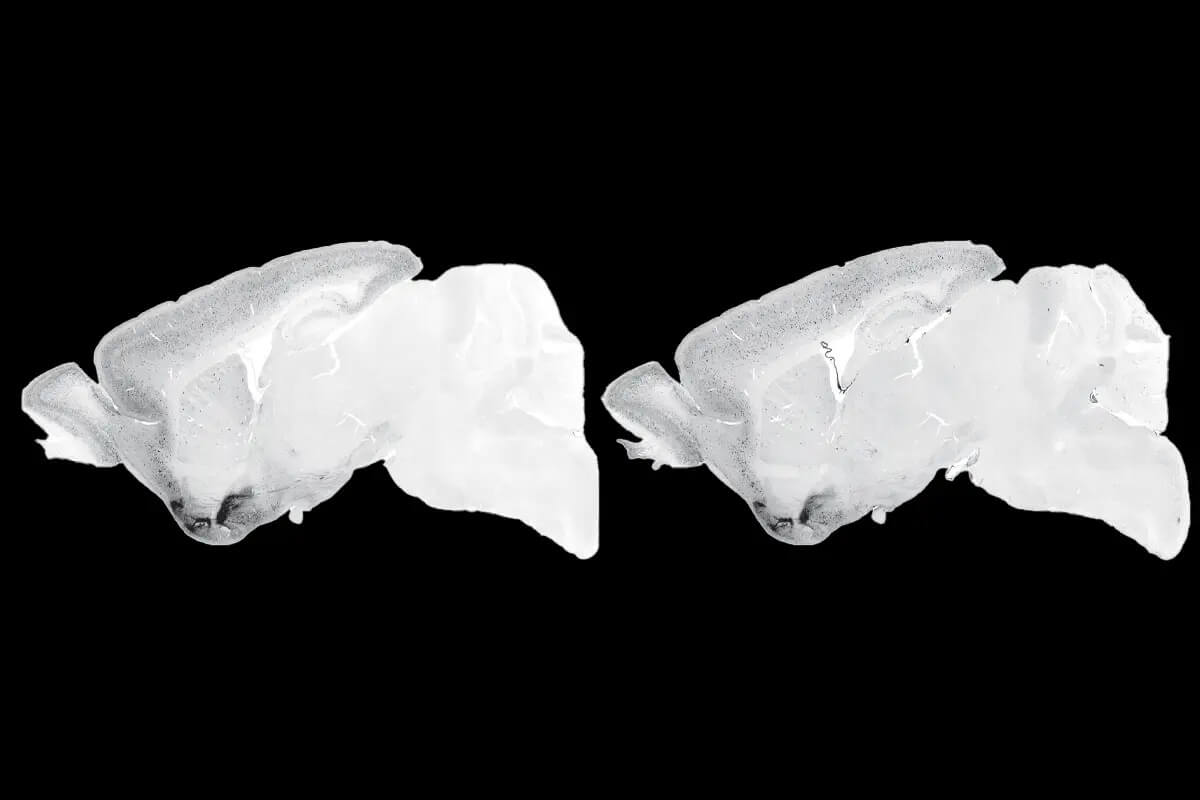 Split Gene Therapy Delivers Promise in Mice Modeling Dravet Syndrome ...